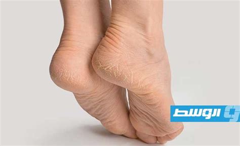 وصفات طبيعية لمنع جفاف الجلد في الشتاء