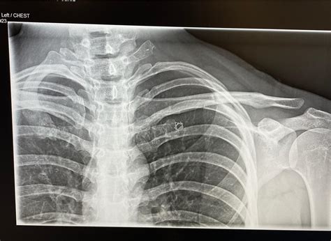 My X Ray Minus A First Rib Thanks Thoracic Outlet Syndrome Rradiology