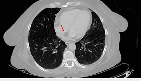 Smooth Non Enhancing Well Marginated 14 9 Mm Mass Visualized On Download Scientific Diagram