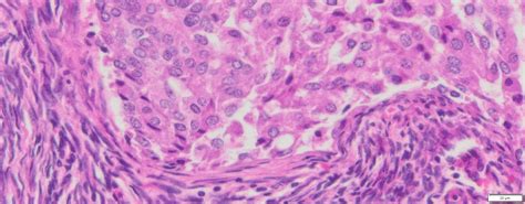 Human Endometrial Cancer Ffpe Sections Human Endometrial Cancer Ffpe Sections