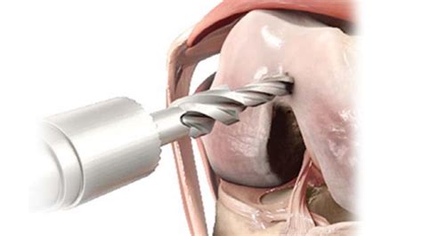 Total Knee Arthroplasty Using The Attune™ Knee System Jandj Medtech
