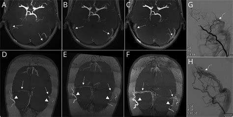 Imaging Evolution Of The Development Of Dural Arteriovenous Fistula