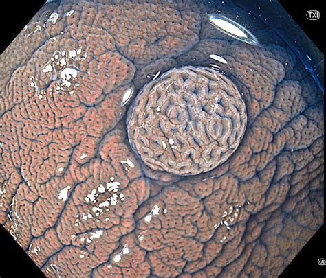 Colorectal Cases Olympus Professional Education On Demand Library