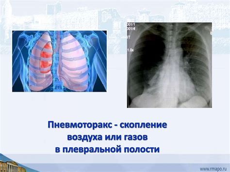 Пневмо- и гемоторакс: клиника, диагностика, неотложная помощь. Лекция ...