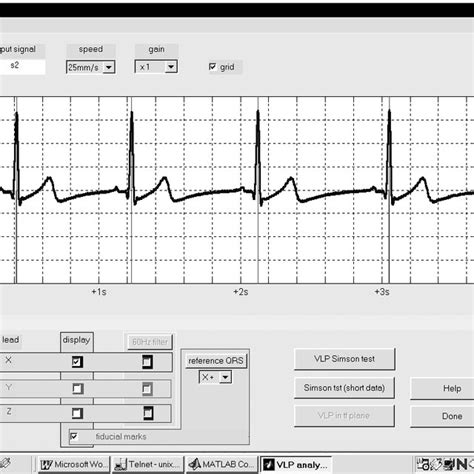 Qrs Detection In Record No 201 Of Mit Bih Arrhythmia Database