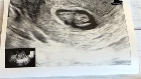 NT Scan Results Abnormal Position BabyCenter