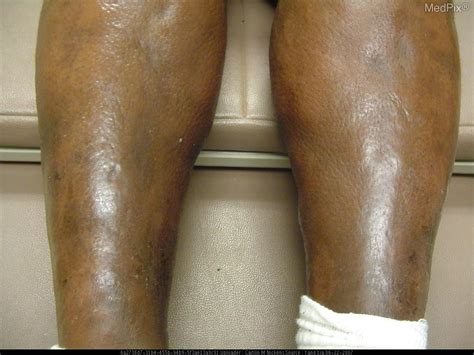 Nephrogenic Systemic Fibrosis