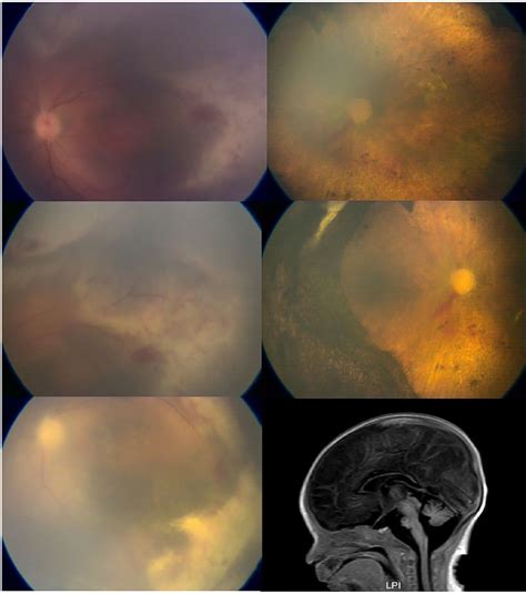 Figure 1 From Acute Retinal Necrosis After Hsv 2 Encephalitis In A Preterm Neonate Semantic