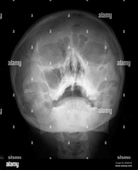 Sinusite Bactérienne Banque De Photographies Et Dimages à Haute