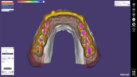 Bite Splint Module Exocad