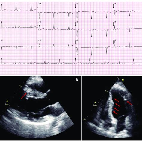 A Electrocardiogram Depicting Sinus Rhythm Poor R Wave Progression Download Scientific