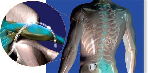 Dorsal Root Ganglion Stimulation Vs Spinal Cord Stimulator