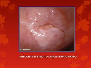 Lesiones Intraepiteliales Y Ca De Cuello Uterino Ppt