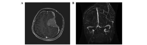 A Head Magnetic Resonance Imaging Revealed A Bilateral Frontoparietal