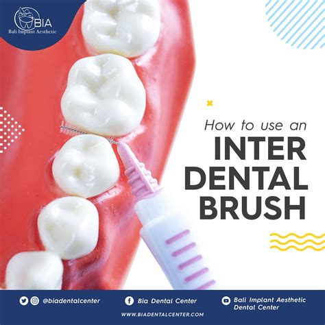 Office Bleaching Whitening Bali Implant Aesthetic Bia Dental Center