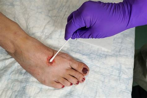 How To Collect An Mpox Specimen For Diagnostic Testing NETEC