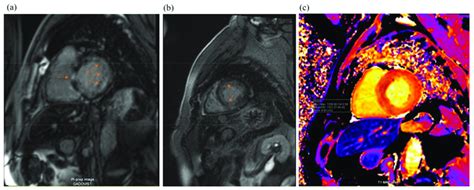Cardiac Magnetic Resonance Imaging Lv Hypertrophy With Diffuse Cardiac Magnetic Resonance Imaging Lv Hypertrophy With Diffuse