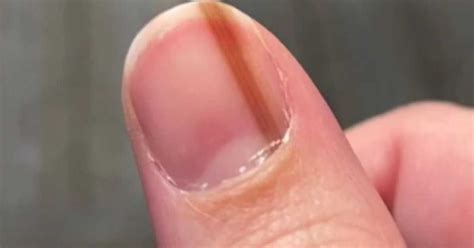 عانت من خط تحت ظفرها لـ10 سنوات ثم اكتشفت حقيقة مدمرة سكاي نيوز عربية