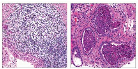 Prostatitis Basicmedical Key