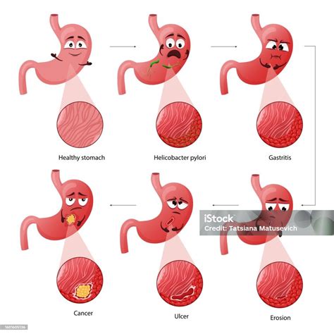 위장병 감정이 있는 만화 캐릭터 다이어그램 질병 헬리코박터 파일로리 위염 침식 궤양 암 교육용 해부학적 벡터 그림입니다 건강관리와 의술에 대한 스톡 벡터 아트 및 기타