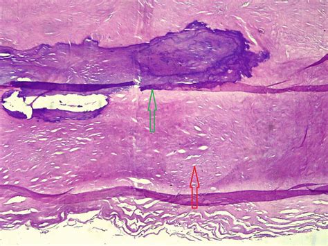Histopathology Section Showing Eggshell Calcification Green Arrow