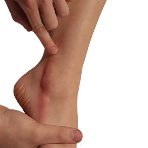 Ankle Tendon Problems Dr Bothma