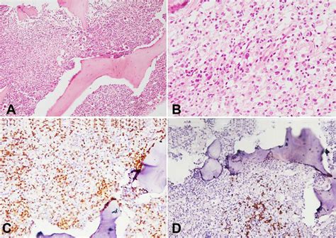 Photomicrographs Of The Bone Marrow A The Core Of Hypercellular Bone