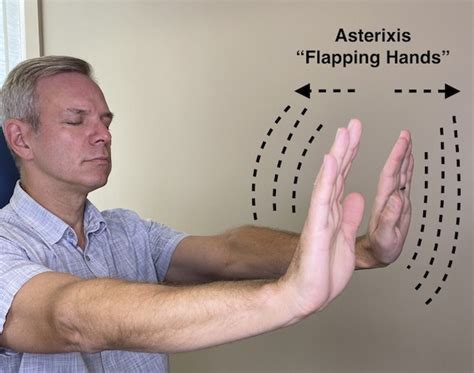 What Is Asterixis Lippincott Nursingcenter