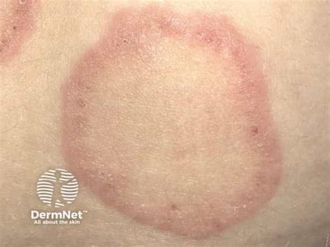 Annular Erythema Images