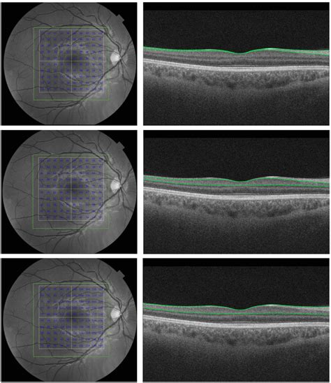 Example Of Fd Oct Generated Inner Macular Thickness Measurements Left Download Scientific