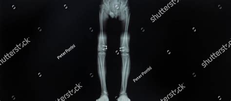 Long Film Of Both Legs Scanogram Shown The Lower Limb Alignment On Dark Background In Case Of