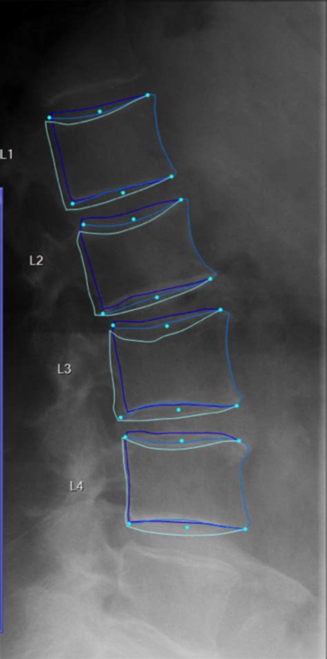 the result of semi automated quantitative vertebral morphometry of l1