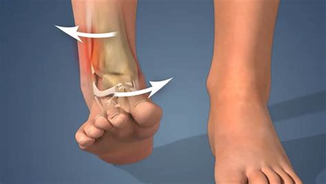 Ankle Sprain High Understandortho™