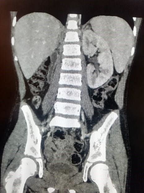 Abdominal Ct Postoperatively With Radical Right Sided Nephrectomy