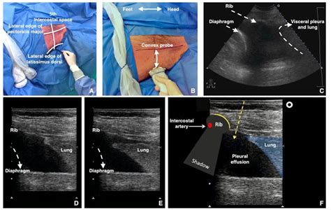 Thoracic Ultrasound Dr Gopal Chawla