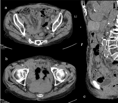 Postoperative Ct Scan 3 Months After The Procedure Shows Complete