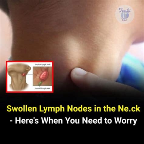 Swollen Lymph Nodes In The Ne Ck Heres When You Need To Worry