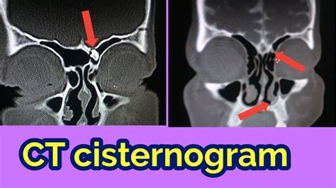 Ct Scan Cisternogram Part 1 2 Youtube