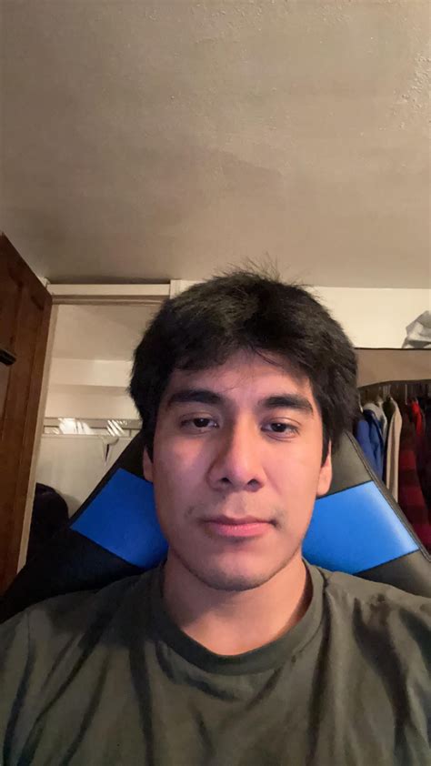 So My Face Is Sooo Flat But My Midface Is A Huge Issue As U Can See