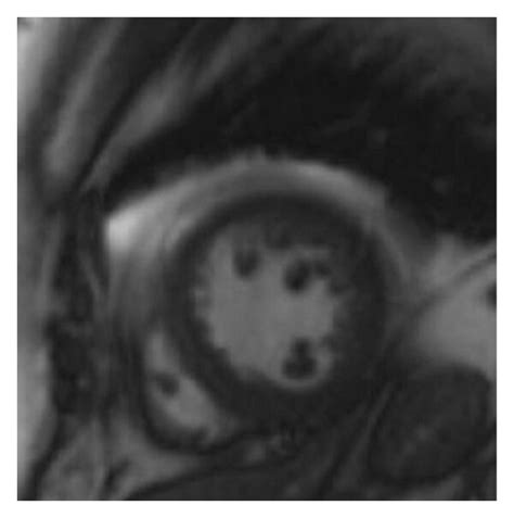 Mid Cavitary View Of The Left And Right Ventricle On Cardiac Mri