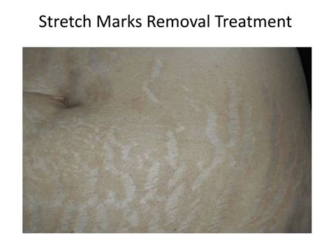 Ppt Stretch Marks Removal Treatment Powerpoint Presentation Free