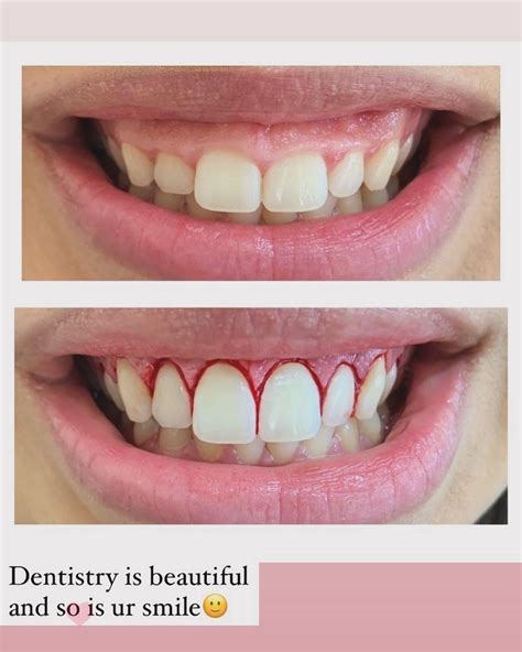 Soft Tissue Lasers Are Like Wands That Can Turn Into A Magic Rishabh