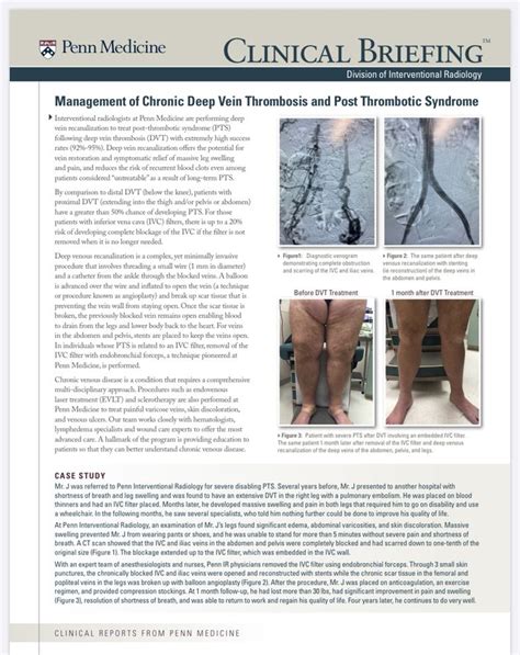 Deep Vein Recanalization Interventional Radiology Post Thrombotic Syndrome Medical Facts
