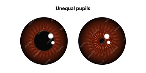 Premium Vector Dilated Pupils Eye Diseases Ophthalmology