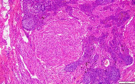 Microscopic Appearance Of The Lymph Node Metastasis 40× Download