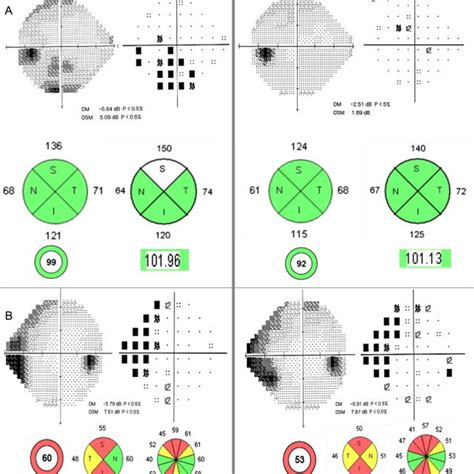 Dominant Optic Neuropathy Bilateral Temporal Pallor And Optic Disk