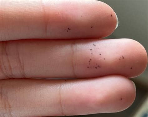 손에 검은색 점 같은거 여러개 지식in