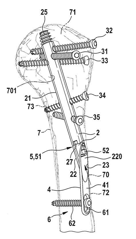 Humeral Epiphysis Patented Technology Retrieval Search Results Eureka Patsnap