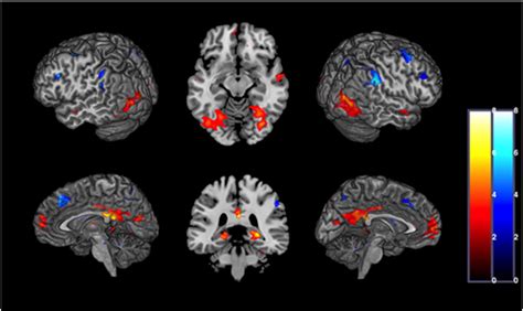 brain activation contrast between visual recursion task vrt and