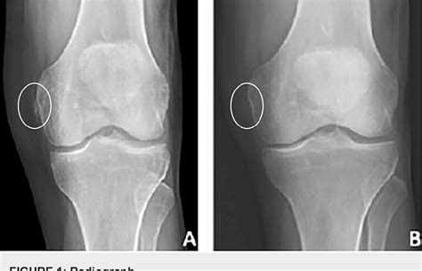 Figure 1 From Heterotopic Mineralization Of The Medial Collateral Ligament Our Experience